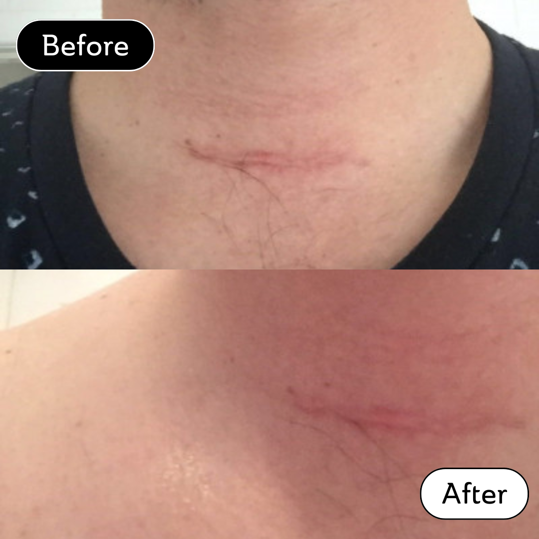 Steve – cancer biopsy* - Scar – Science of Skin