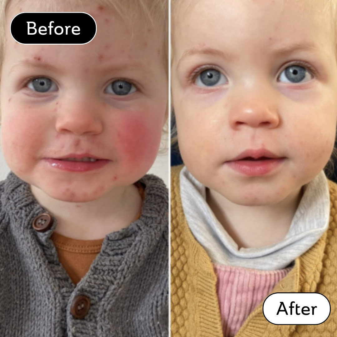 Agnes* - Chicken Pox scar – Science of Skin