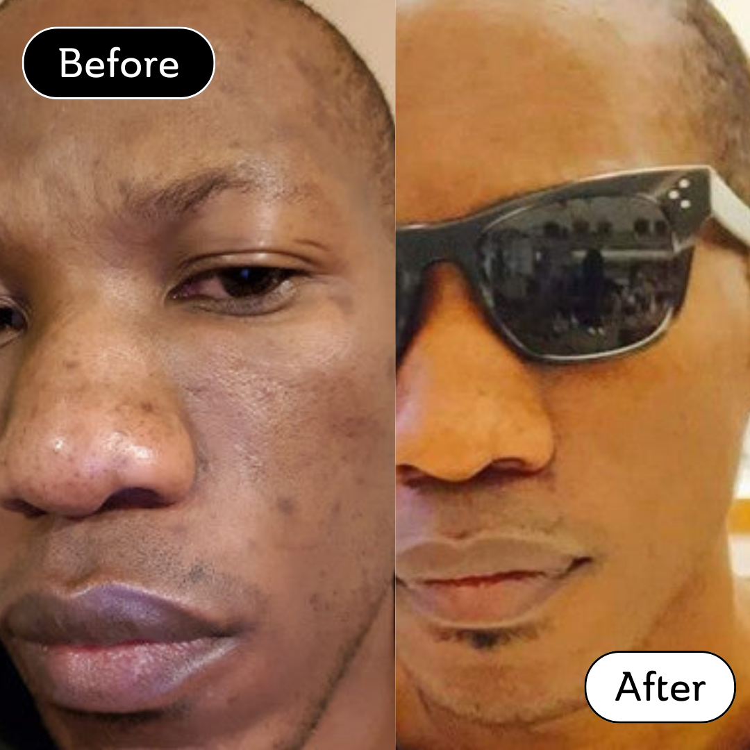 Joel* - Acne scar – Science of Skin
